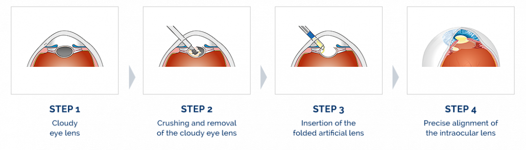 cataract-artificial-lens-intraocular-lens-treatment-surgery | HumanOptics