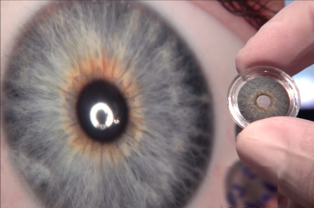 artificial-iris-iris-defect-individual-treatment-patient-02-humanoptics ...