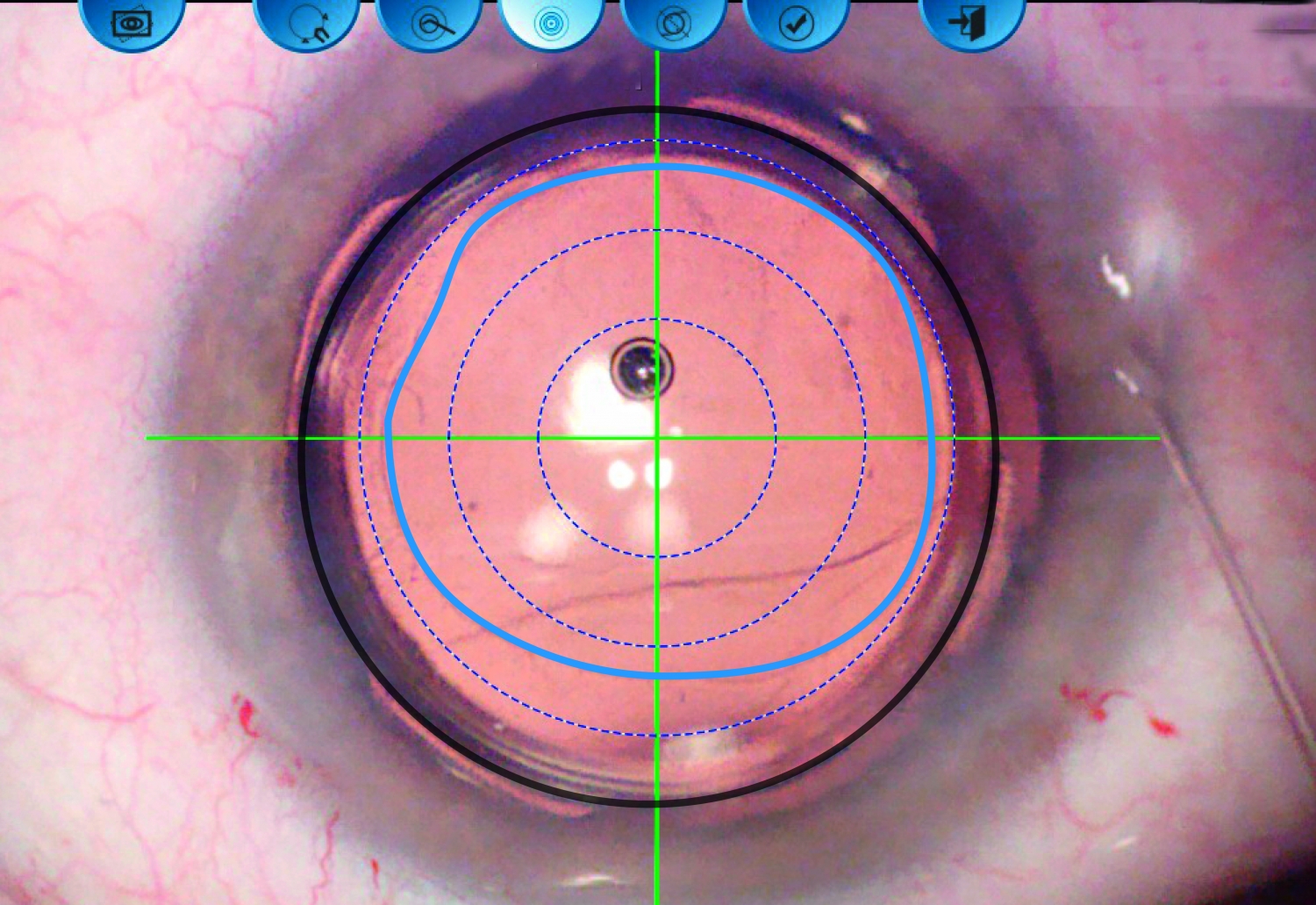 Rhexisdurchmesser-aXA | HumanOptics