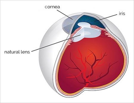 iris-defect-injury-treatment-patient-artificial-iris-humanoptics ...