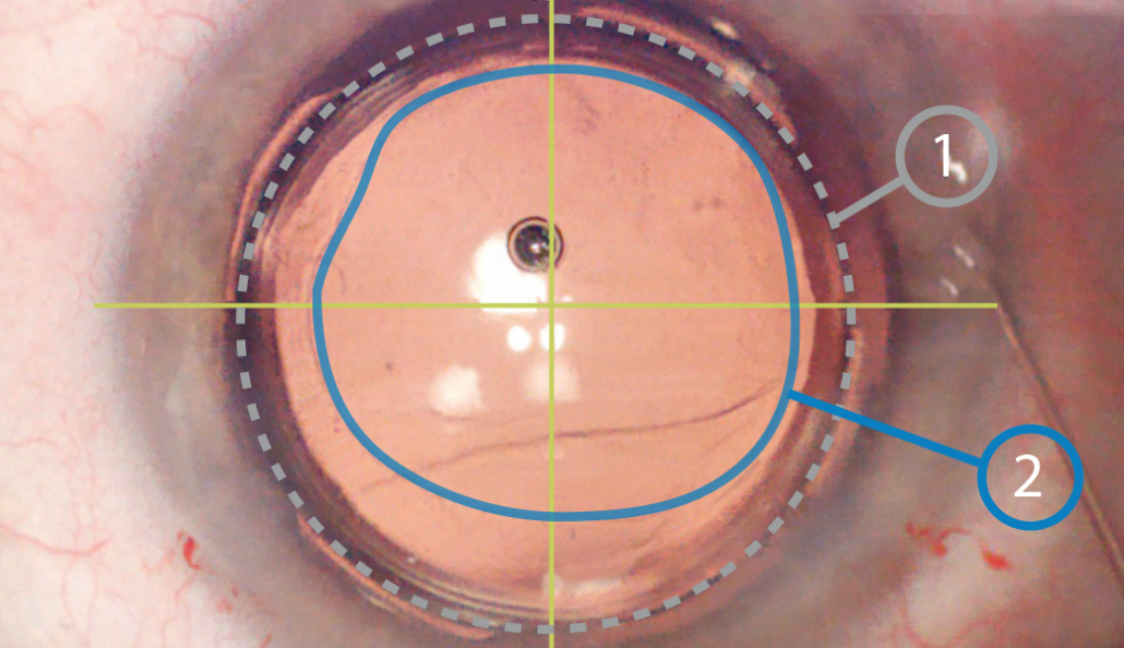 aspira-axa-7-mm-optic-large-rhexis-preloaded-iol-k-humanoptics ...